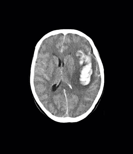 Aneurysmal subaraknoidalblödning – Läkartidningen
